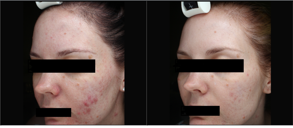 Active Acne - Skin Alert Cairns Skin Cancer and Cosmetic Clinic