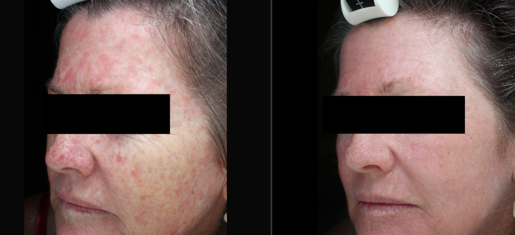 PhotoDynamic Therapy - Skin Alert Cairns Skin Cancer and Cosmetic Clinic
